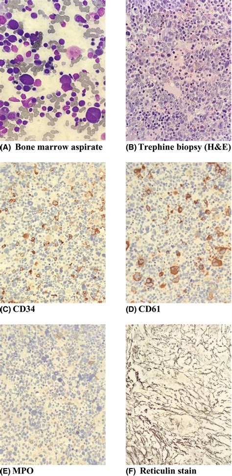 A The Bone Marrow Aspirate Demonstrates Hypercellularity For Age