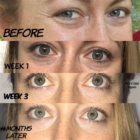 Before And After Results Eye Cream Dark Eye Circle Senegence