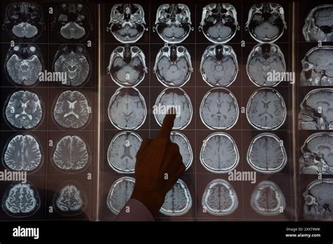 A Healthcare Professional Examines Multiple Mri Brain Scans Displayed On A Screen Focusing On