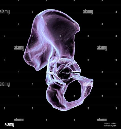 Illustration Of Pelvic Bones With An Acetabulum Fracture A Break In