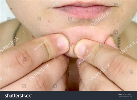 Mens Pimple Treatment Before After Image Stock Photo 697384315 Shutterstock