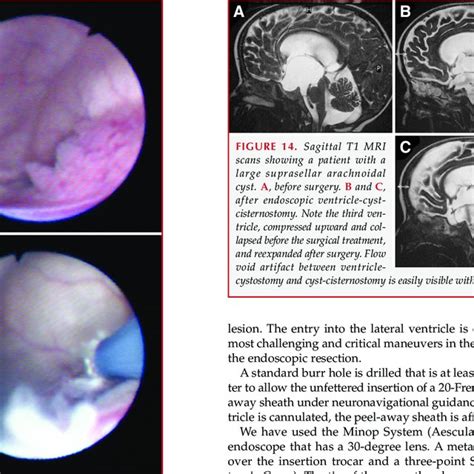 A And B Cauterization Of The Choroid Plexus In The Temporal Horn