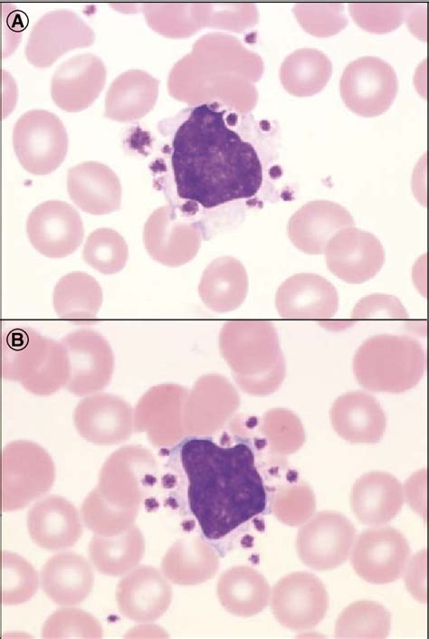 Atypical Lymphocyte Vs Monocyte