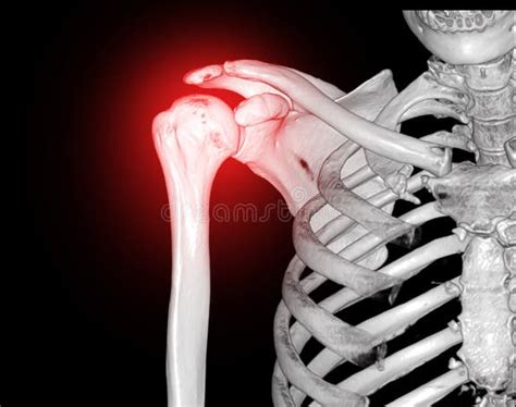 Ct Shoulder 3d Stock Illustration Illustration Of Patient 257208900