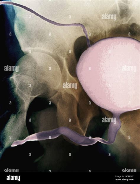 Voiding Cystourethrogram Coloured X Ray Of A 54 Year Old Male Patient Undergoing A Voiding