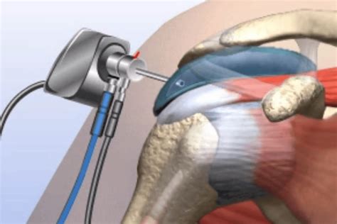 Shoulder Arthroscopy For Subacromial Decompression Ishaan Ortho And Spine Clinic Bangalore
