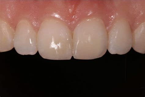 Class Iv Restoration Replacement Myzerodonto