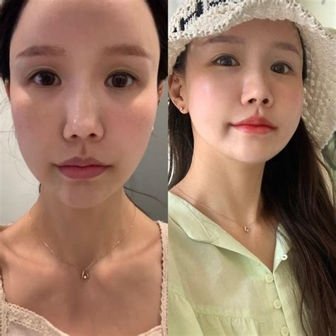 신논현역피부과 쥬베룩 스킨부스터 후 효과 부작용 후기 네이버 블로그