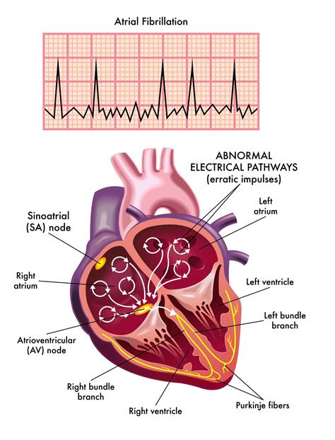 Atrial Fibrillation Graph