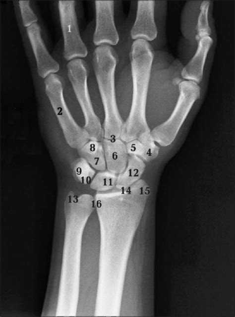 Рис. 46. Рентгенограмма лучезапястного сустава в прямой проекции