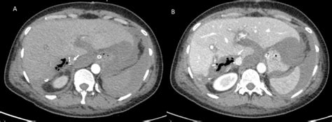 Hepatic Abscess In Resected Hepatocellular Carcinoma On Vi Hepatic