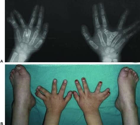 Metacarpal Synostosis Duplicated And Tightly Fused Symmetrically Bifid