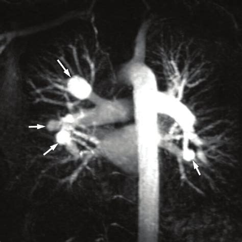 Perfusion Lung Scintigraphy With 99mtc Maa Multiple Segmental Defects Download Scientific