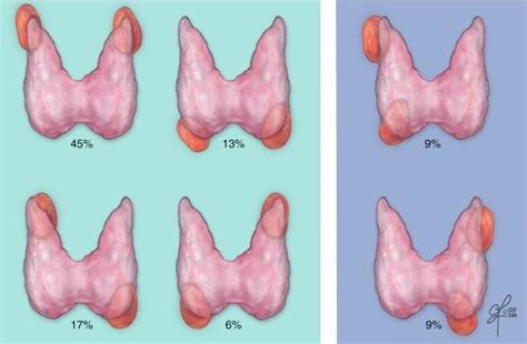 Standard Bilateral Parathyroid Exploration Clinical Tree