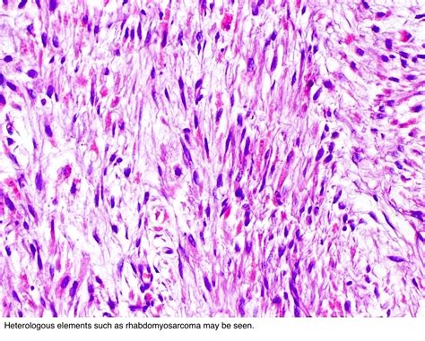 Pathology Outlines Müllerian Adenosarcoma