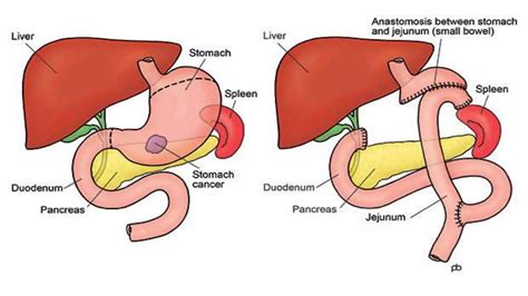 Gastrointestinal Stromal Tumours Gistpptx