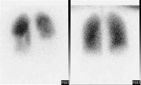 Ventilation Perfusion Scintigraphy Posterior View In A Patient With
