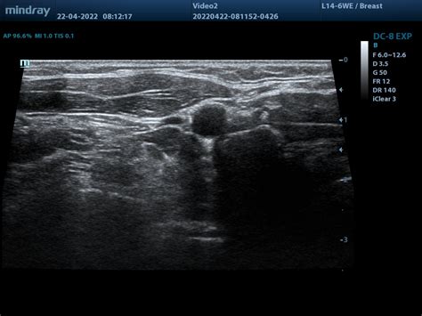 Carotid Artery Object Detection Dataset And Pre Trained Model By Project 351kq
