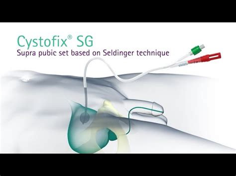 Suprapubic Cystostomy Tube