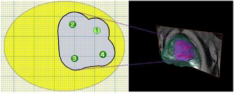 The Ablation Zone Reconstruction On Mri Using Volume Generating Download Scientific Diagram