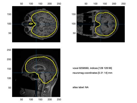 Creation Of Headmodels And Sourcemodels For Source Reconstruction Fieldtrip Toolbox