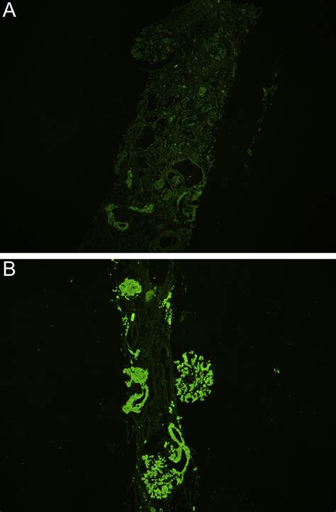 Ajkd On Twitter Renalpath Al Amyloidosis With λ Light Chain