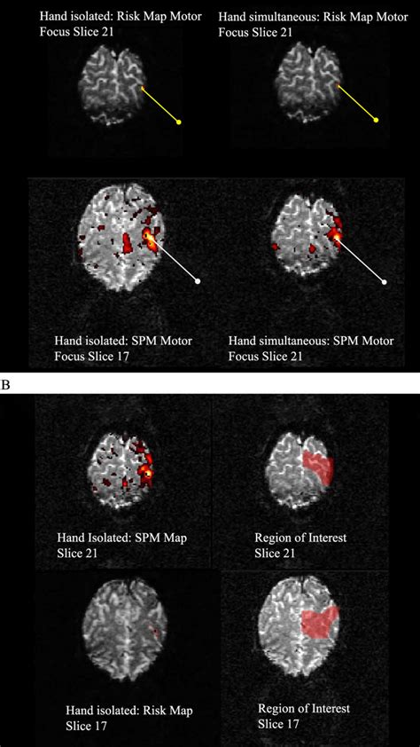A Subject Bj Localization Of The Hand Motor Center With Non Smoothed Download Scientific