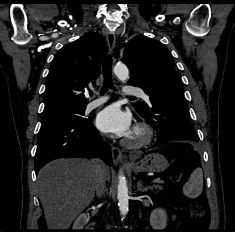 Subpulmonic Effusion