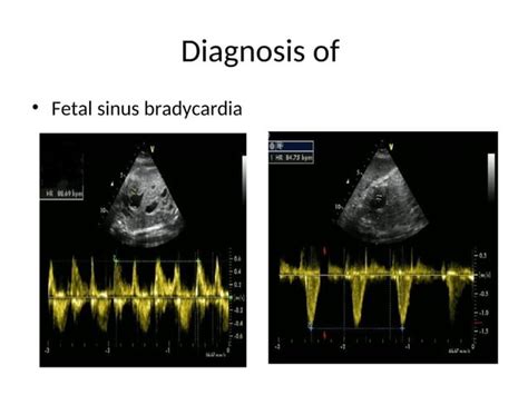 Fetal Arrhythmia Diagnosis And Management Ppt