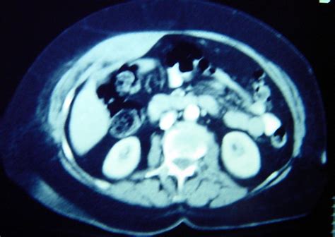 Rectus And Abdominal Wall 0882 Rectus Hematoma 1 Surgery Photos