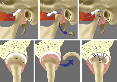 Condylar Hyperplasia Of The Temporomandibular Joint Oral And