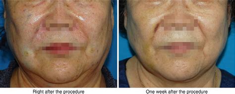 Complications Of Thread Lift And How To Manage Thread Protrusion Inf