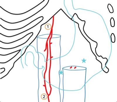 Updates On Percutaneous Radiologic Gastrostomy Gastrojejunostomy And Jejunostomy PMC