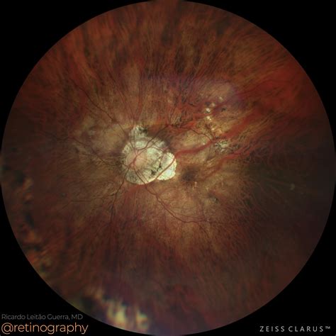 Pathologic Myopia And Macular Hole Retinography