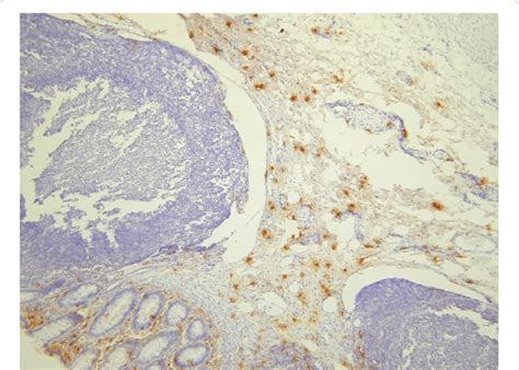 Hirschsprungs Disease Cross Section Of The Aganglionic Colon