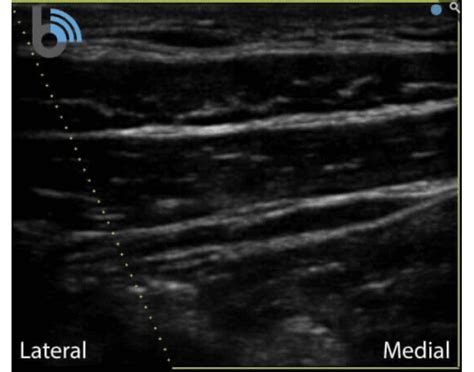 Ilioinguinal Iliohypogastric Block Quiz