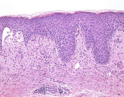 Urticarial Bullous Pemphigoid
