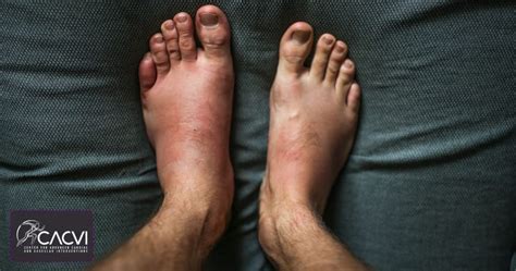 How Much Does Hemosiderin Staining Laser Treatment Cost