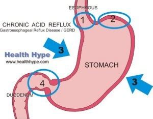 Chronic Reflux Persistent Constant Recurrent Acid Reflux Healthhype