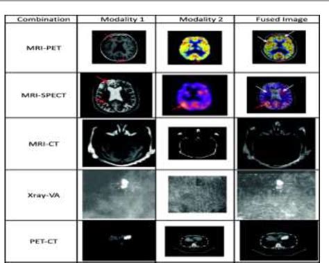 Figure 3 From Multimodal Image Fusion By Using Non Subsampled Contourlet Transform Semantic