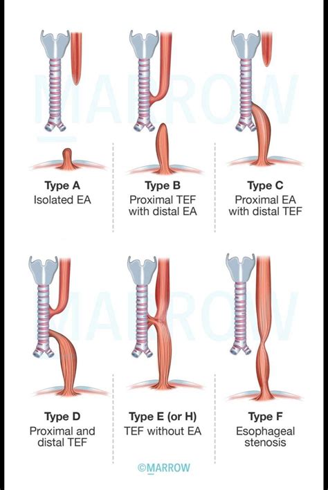 Tracheoesophageal Fistula Medical School Essentials Medical