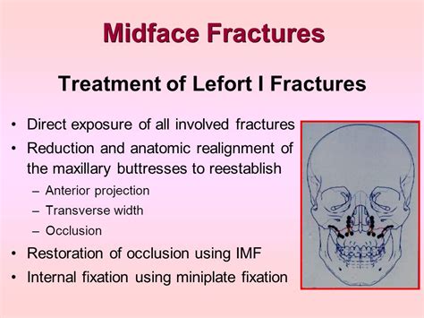 Maxillary Fracture Classification