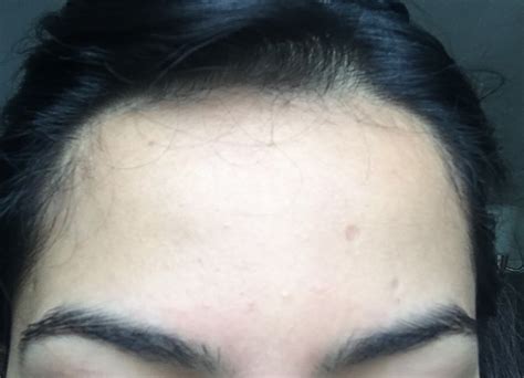 How Can I Get Rid Of Tiny Bumps Covering My Face General Acne Discussion Acne Org Forum