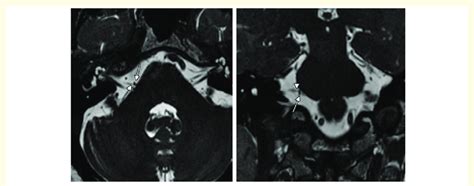 Arterial Contact Along The Proximal Cisternal Segment Of The Facial