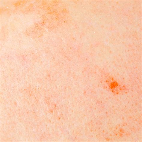Information About Skin Problems What You Need To Know Ivatherm