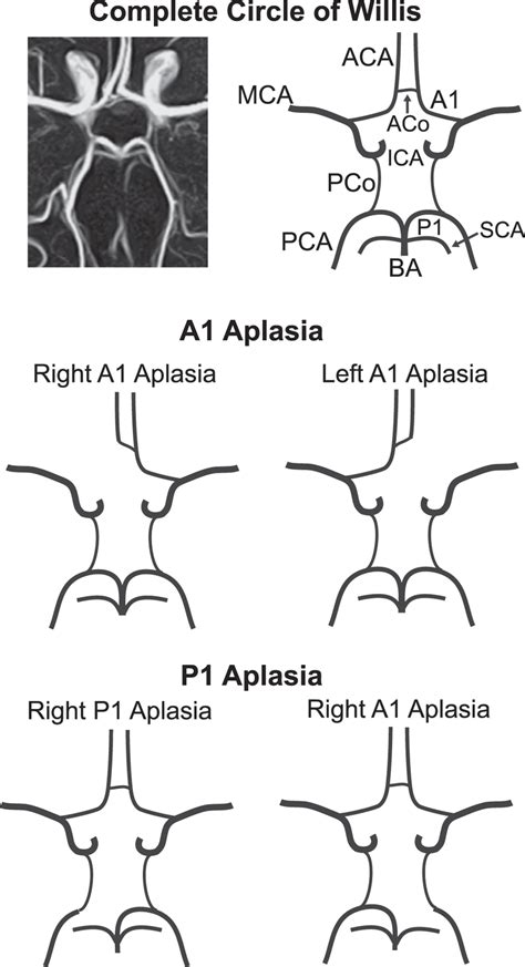 Anatomy Of The Complete Circle Of Willis Top Along With The A1 Download Scientific Diagram