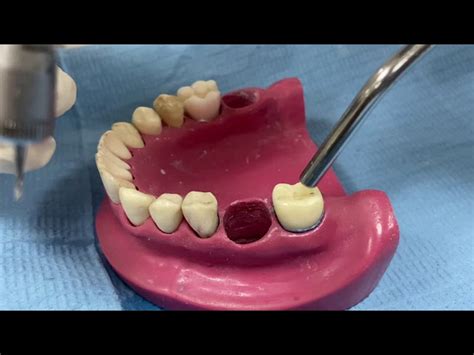 Class I Cavity Preparation For Composite Mandibular Molar 51 Off