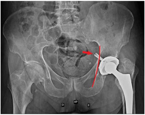 Pelvis Anteroposterior Radiograph Demonstrating Two Screws Red Arrow