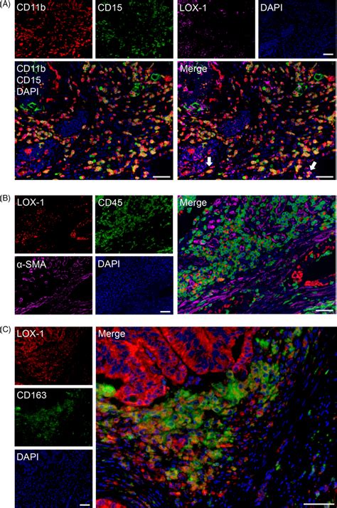 Evaluation Of Lox‐1⁺ Cells Using Multiplex Immunofluorescence In Crc