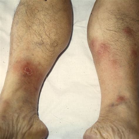 Chronic Nodular Hypodermitis Of The Lower Limbs Download Scientific Diagram